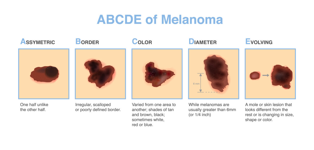 Types of Skin Cancer - Edmonton Dermatology