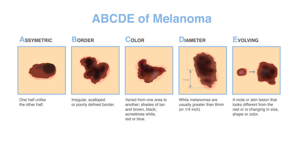 Types of Skin Cancer - Edmonton Dermatology