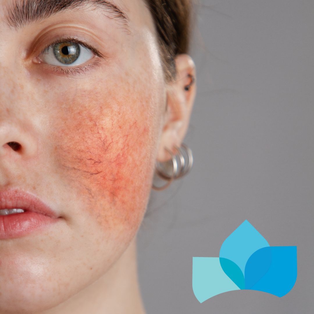 How To Treat Rosacea - Edmonton Dermatology